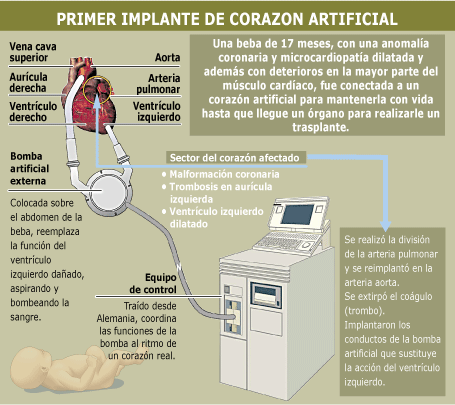 Realizan el primer implante de corazón artificial en el país