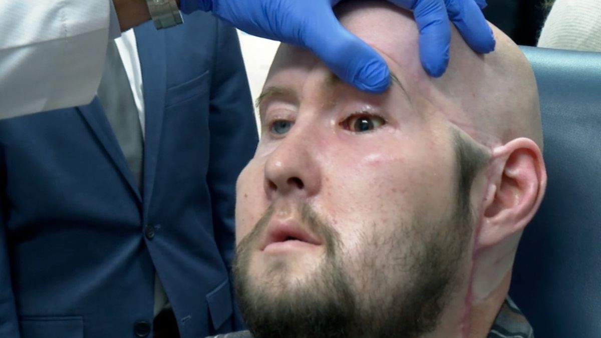 Un hombre recibió el primer trasplante de ojo completo en el mundo