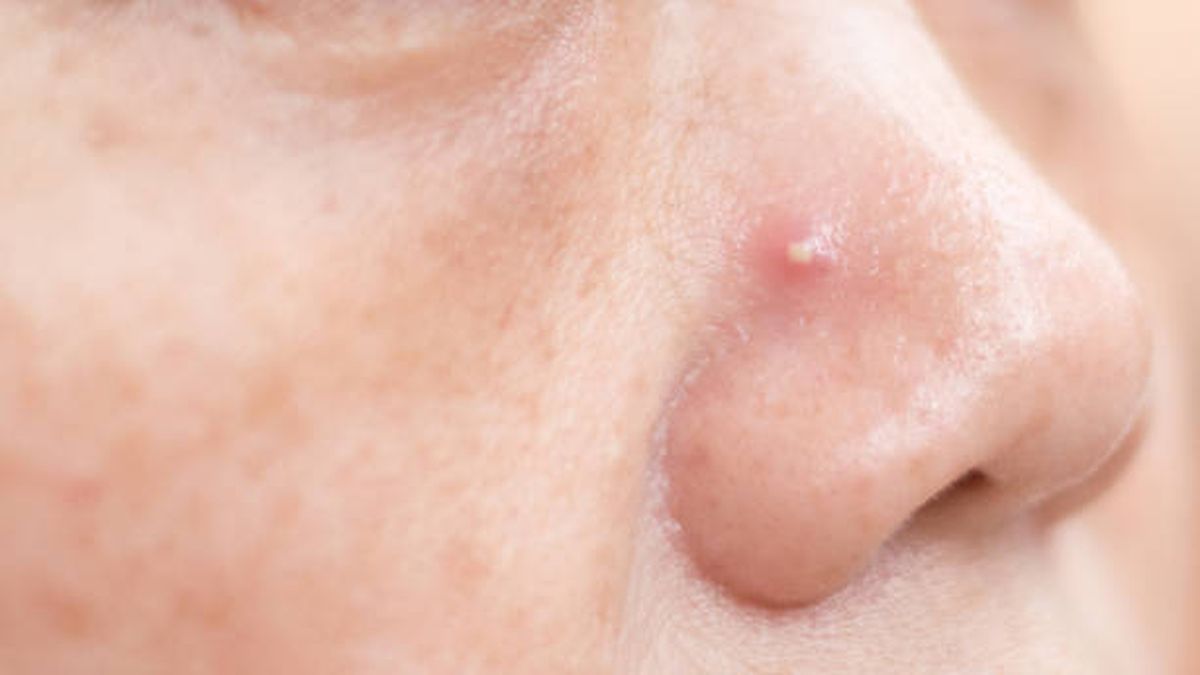 5 consejos para combatir los granos de la piel