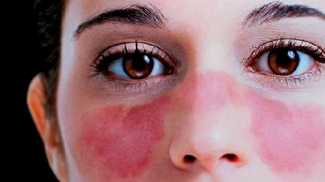Día Mundial del Lupus: qué es, cómo se desarrolla y algunos mitos sobre ...