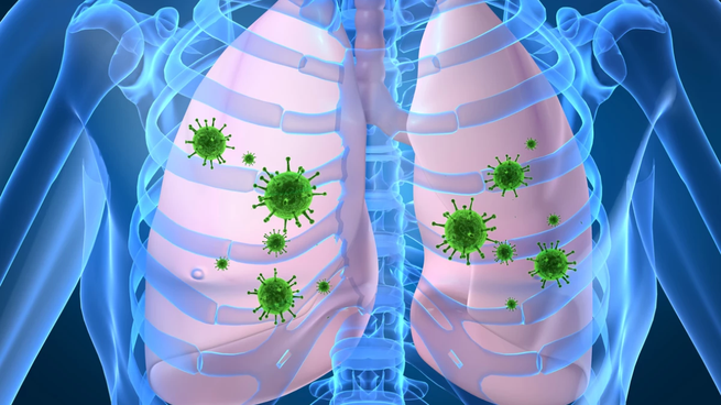 Día Mundial contra la Neumonía: por qué es importante esta fecha