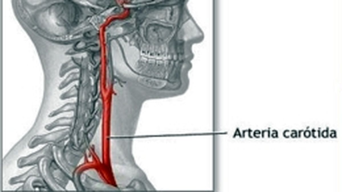 Cómo es la cirugía de arteria carótida