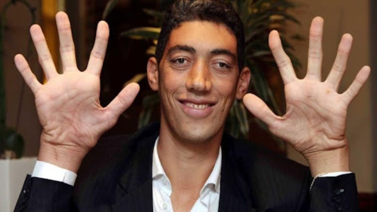 Día Mundial de la Acromegalia, la enfermedad de las manos y pies gigantes