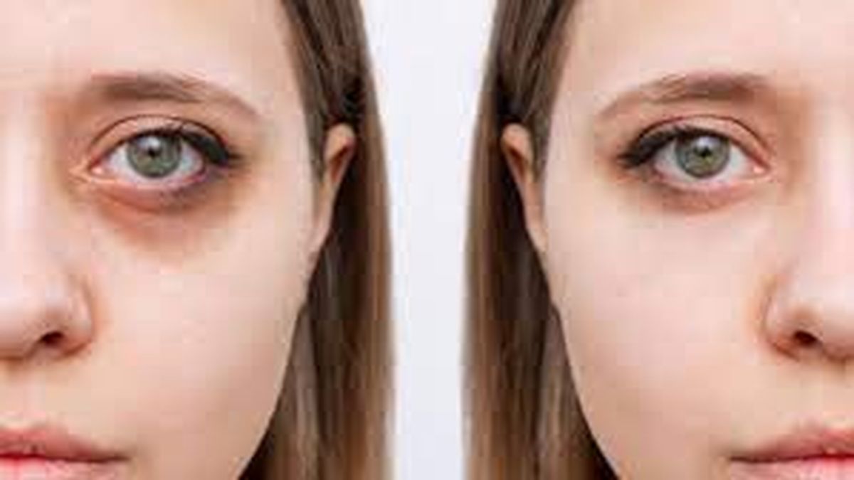 Ojeras: ¿por qué surgen y cómo combatirlas?