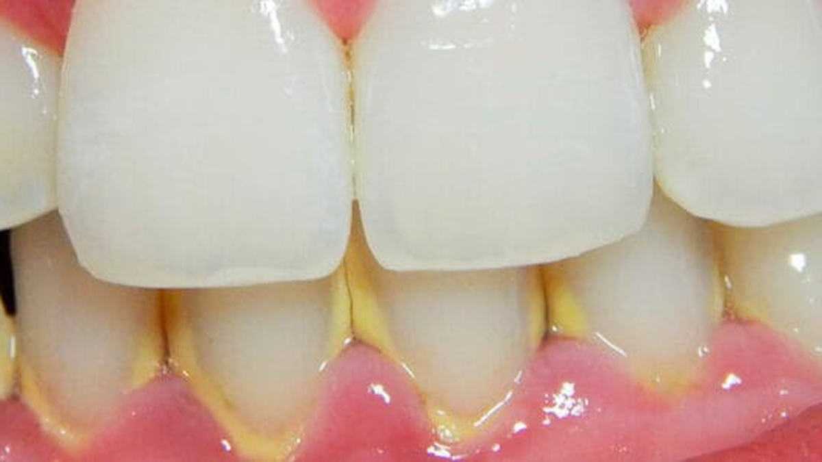 Cómo eliminar de manera definitiva el sarro de tus dientes con este ...