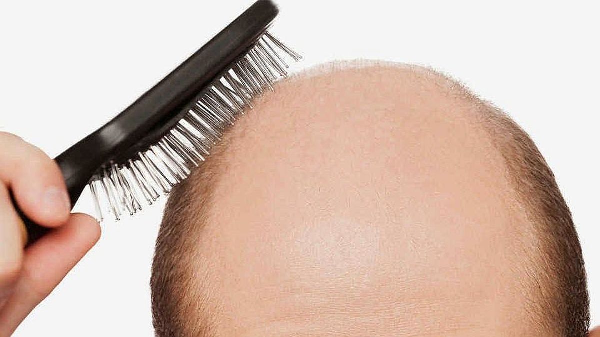 Identifican más de 200 genes vinculados con la calvicie