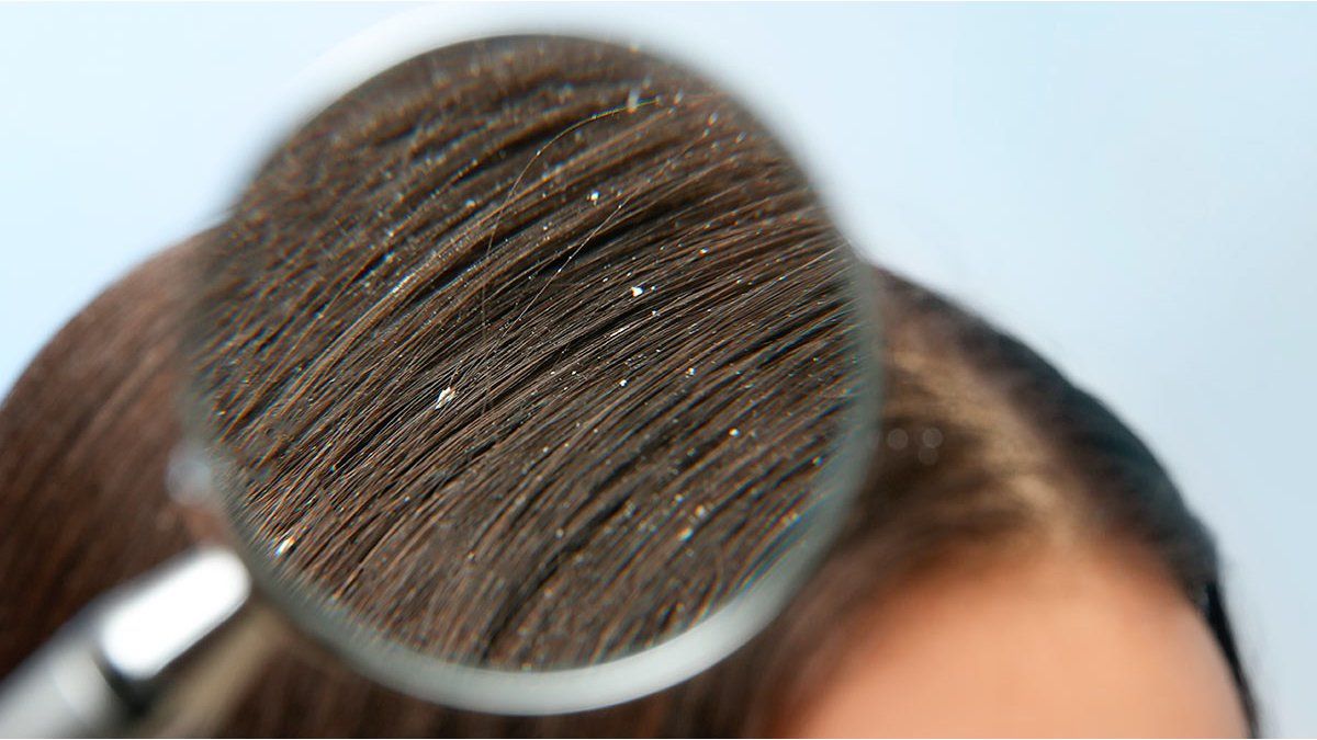 Harvard reveló cómo combatir la caspa: conocé el particular método