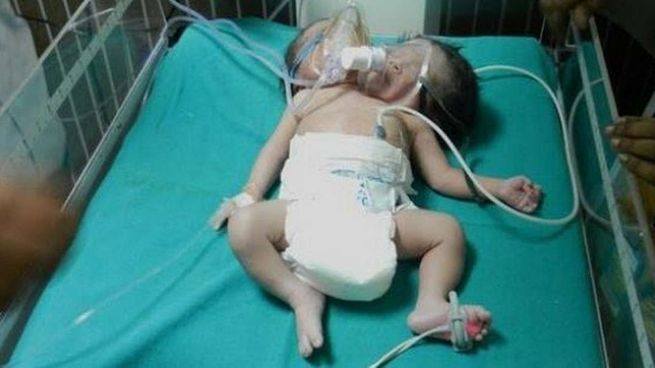 Un bebé con dos cabezas, tres manos y dos corazones espera un milagro ...