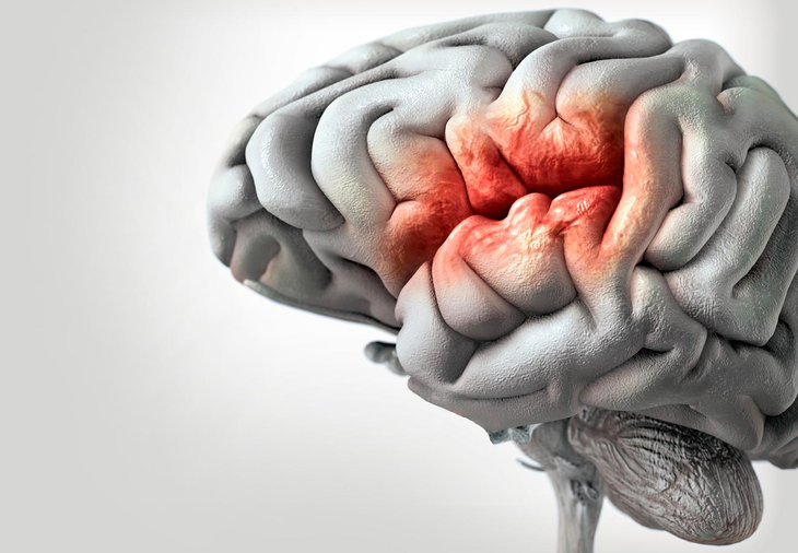 ACV: cuáles son los síntomas y cómo debo actuar