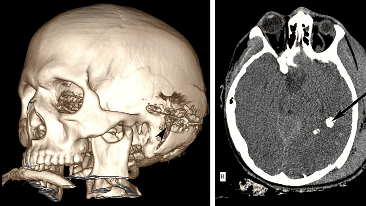 Cerebro, presión y vida: por qué a veces es necesario abrir el cráneo ...