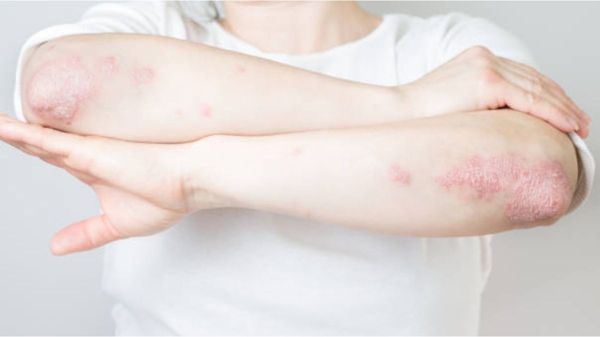 La psoriasis pustulosa generalizada ya tiene tratamiento en Argentina ...