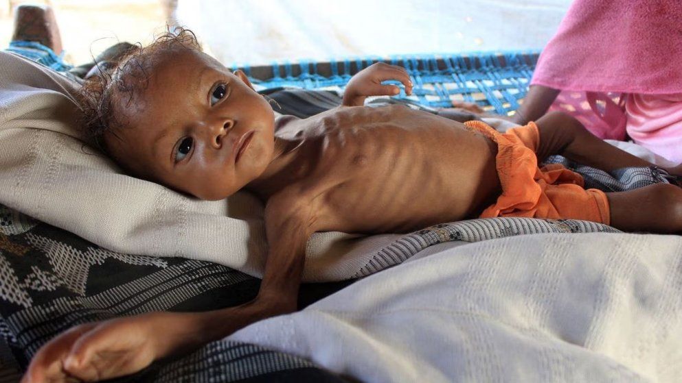 desnutrición. Últimas noticias de desnutrición | Ambito.com