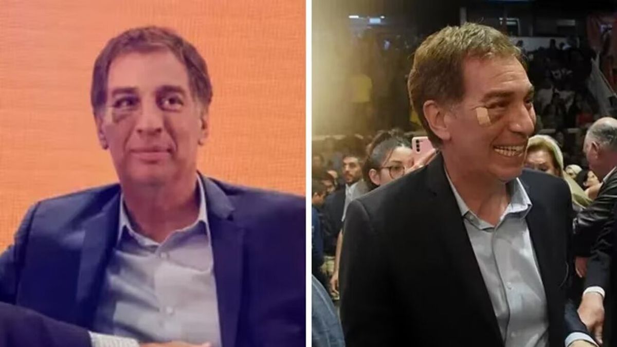 Diego Santilli tuvo un accidente en el gimnasio: No me sacó un ojo de ...